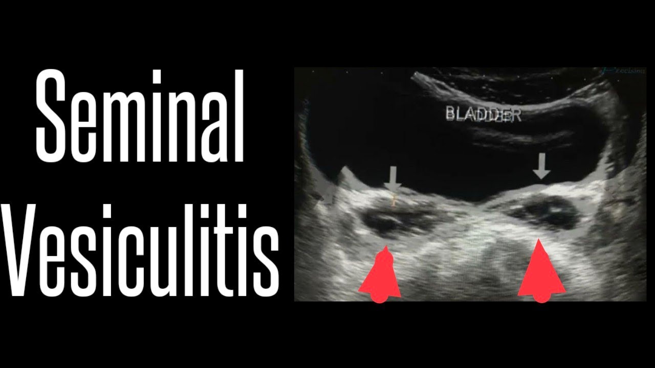 Seminal Vesiculitis | Painful Ejaculation | Pelvic pain | Infertility ...