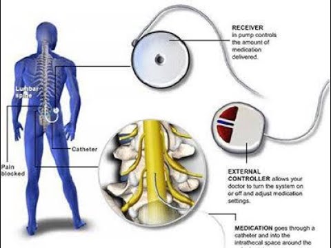 Spinal cord stimulation And intrathecal pumps; advanced pain management ...