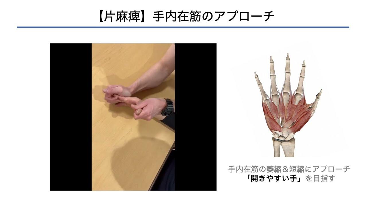 【片麻痺】手内在筋のアプローチapproaches To The Muscles Of The Hemiplegic Hand Youtube