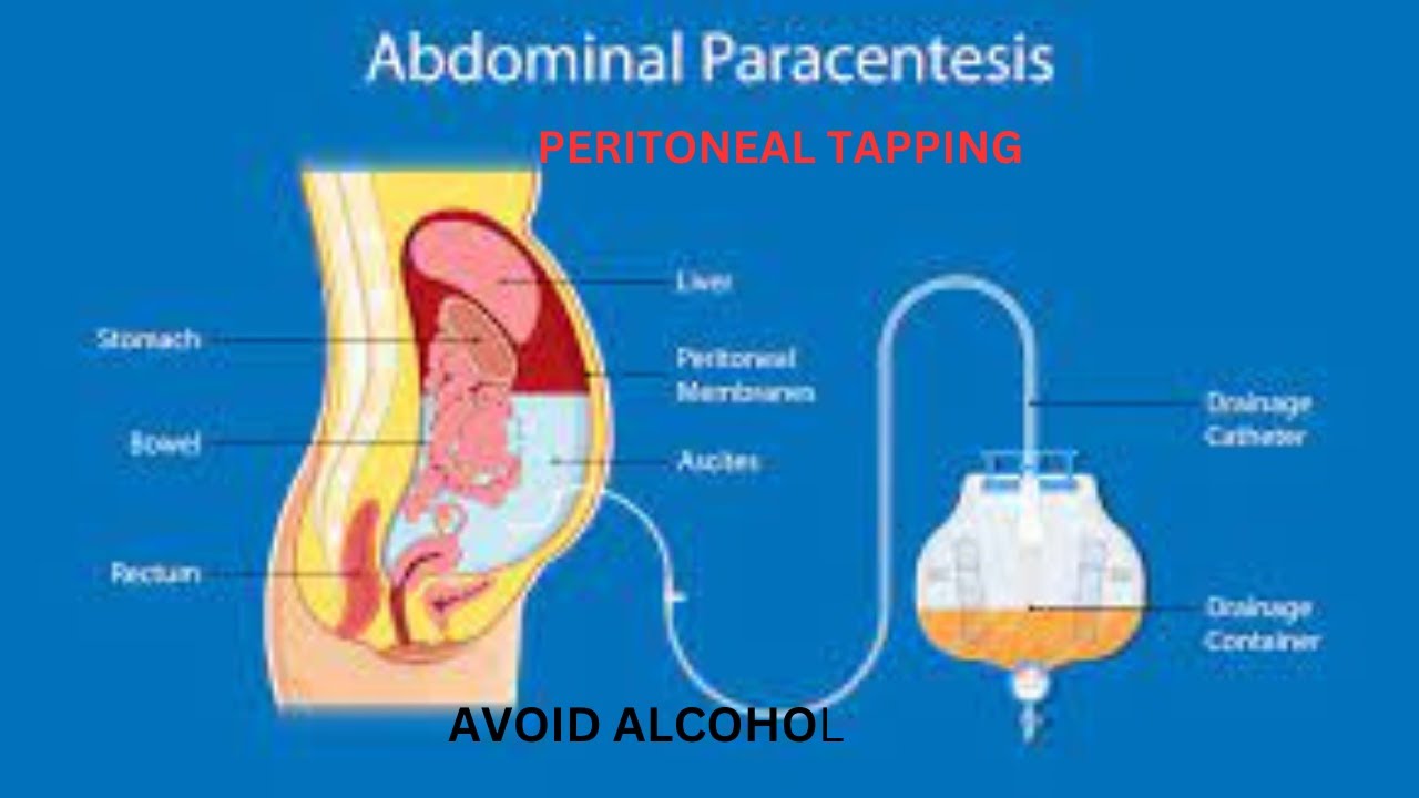 Peritoneal Tapping @razefirexplod - YouTube