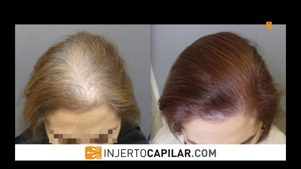 1301 FUE Grafts. Female AGA LW II. Injertocapilar.com.2039/2017 - YouTube