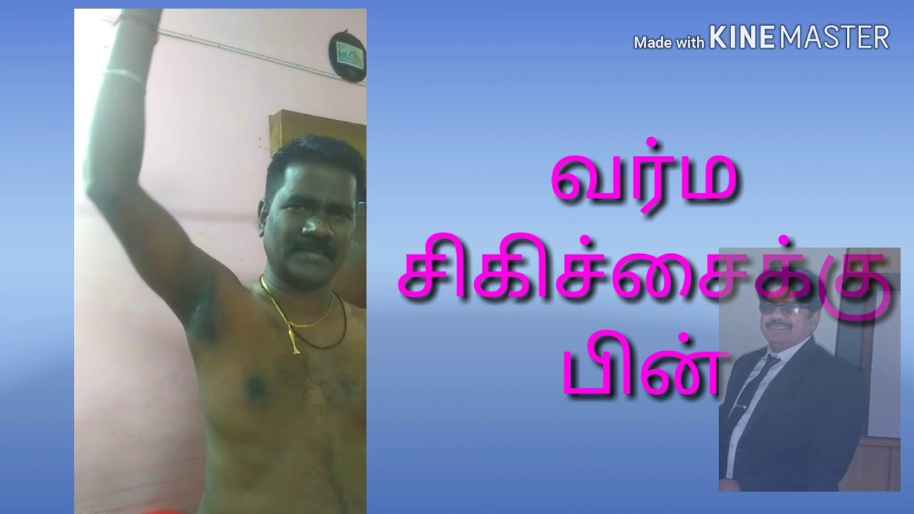 Secrete Varma - Marma Points for Shoulder joint pain | Treating within ...