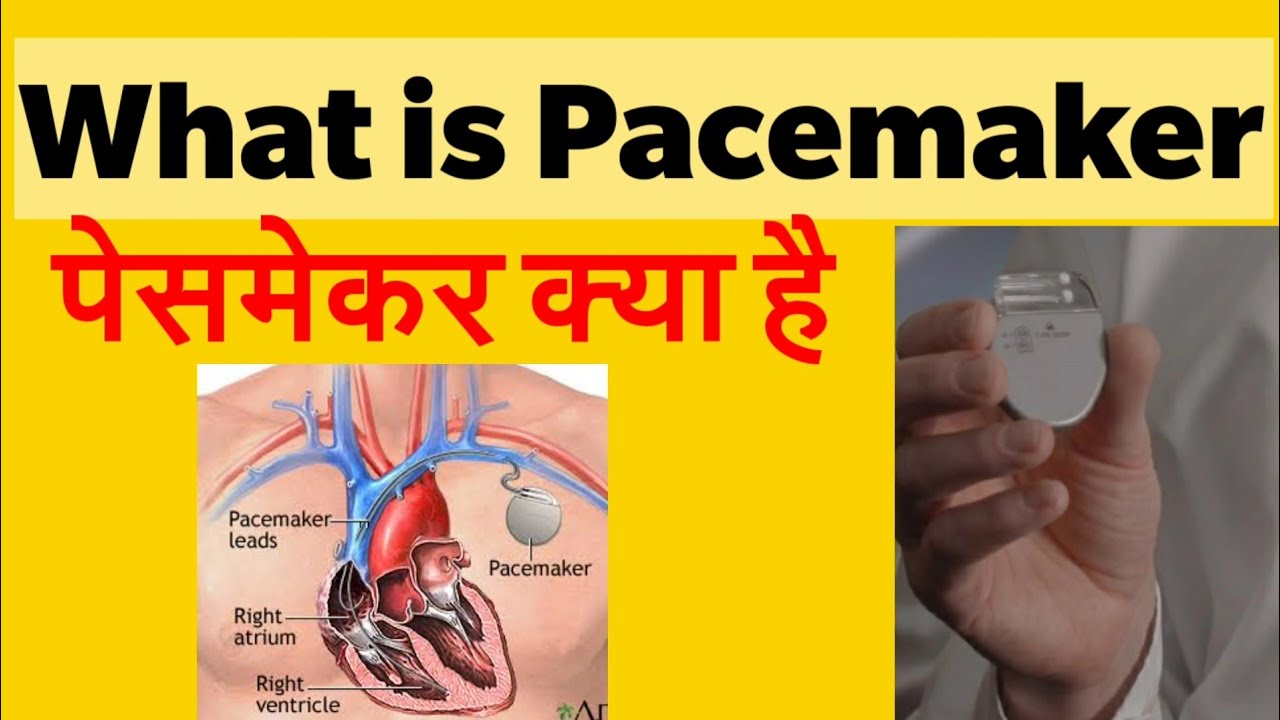 What is Pacemaker | Short Note | Pacemaker | पेसमेकर क्या है | Science ...