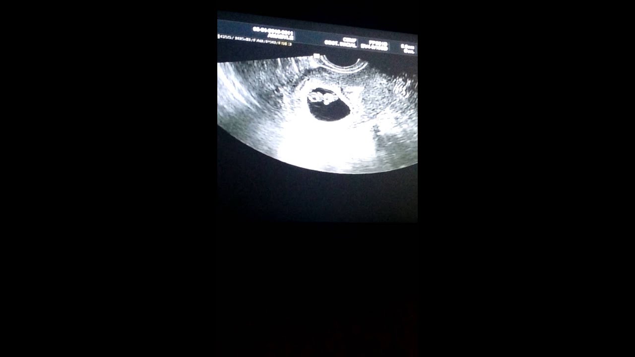 Primeiro Ultrasom 8 semanas de gravidez - Baby lindo a bordo - YouTube