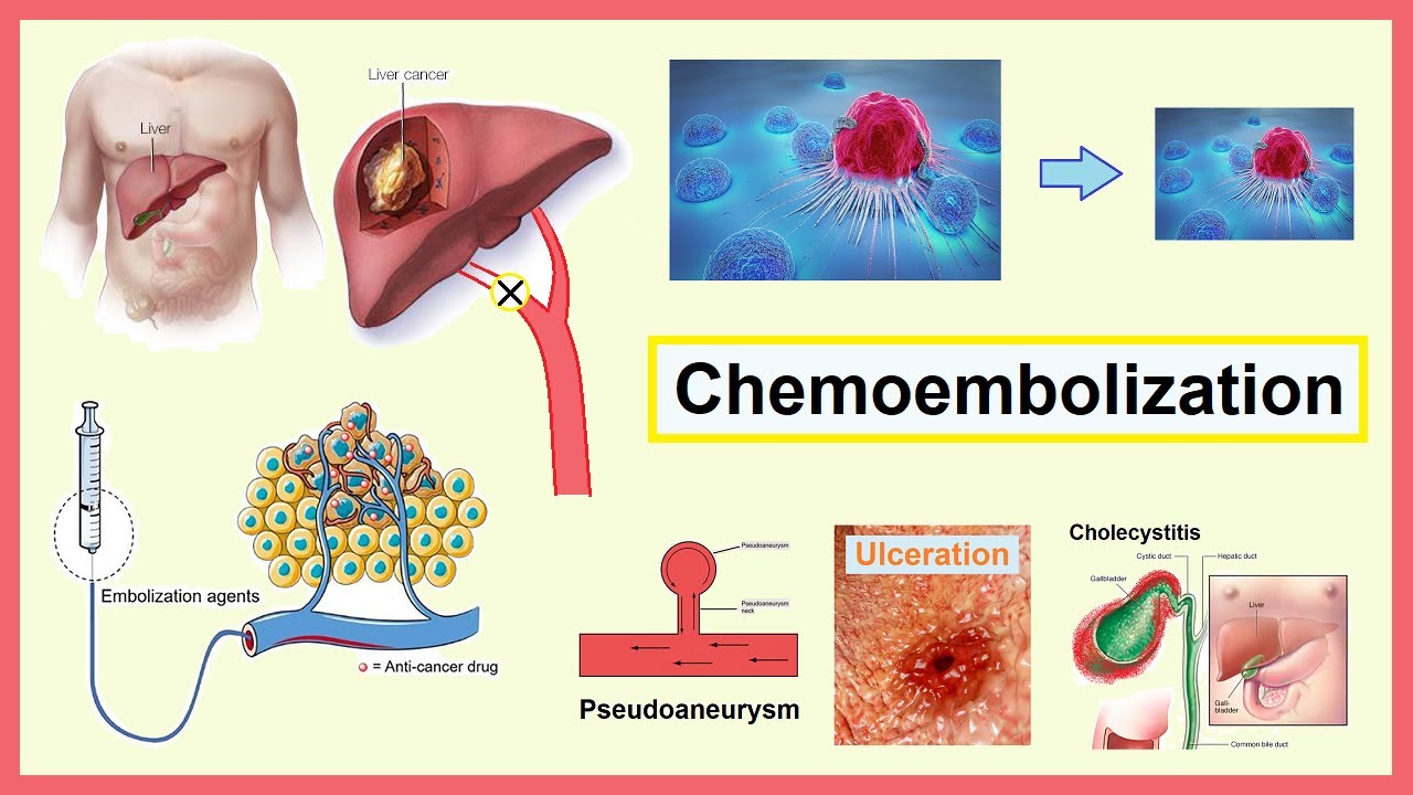 chemoembolization - YouTube