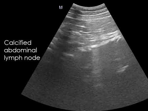 Lymph Node Calcification: Abdomen Causes EXPLAINED! - learnfast.blog
