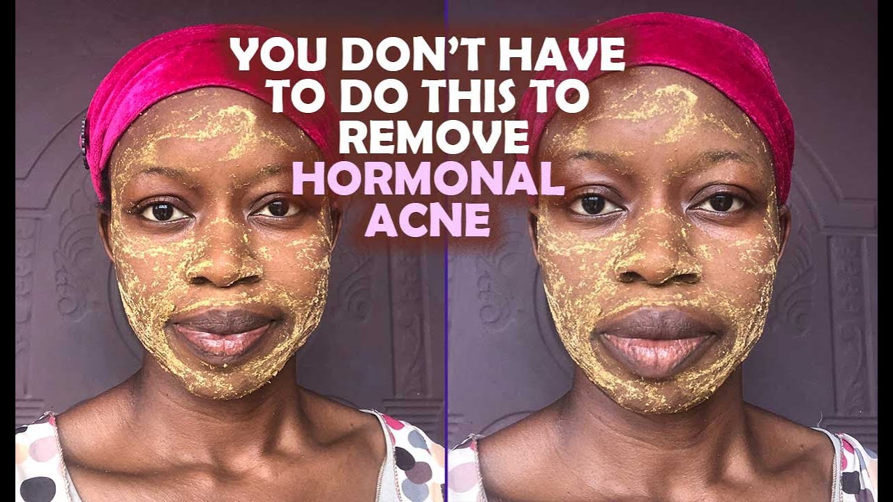 Your Acne Will Disappear In 3 Days - YouTube
