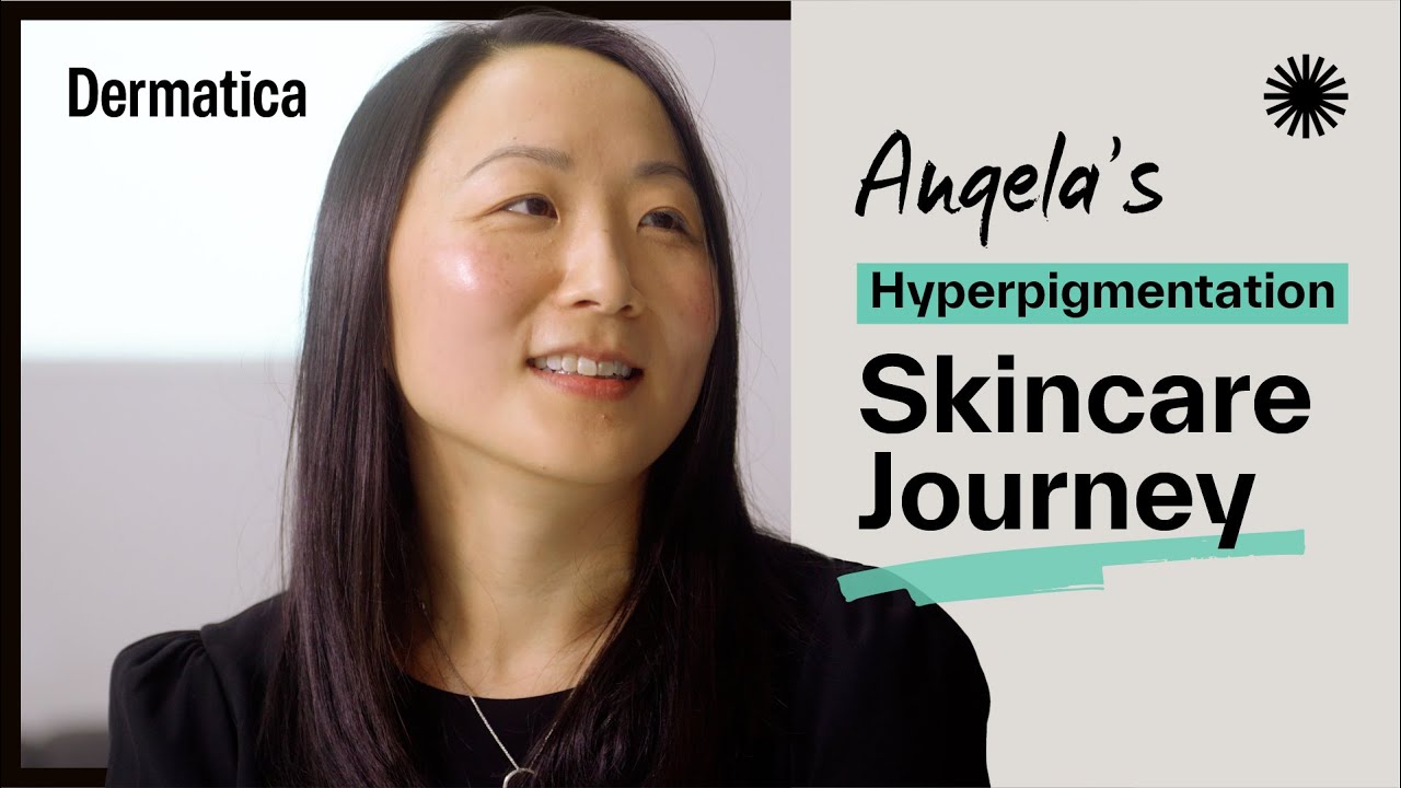 My Hyperpigmentation Treatment Skincare Journey - Angela - YouTube