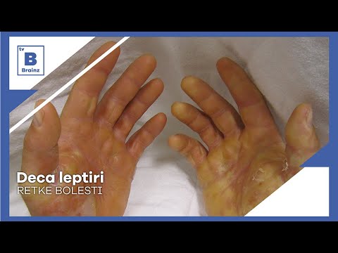 Retke bolesti - Deca leptiri - YouTube