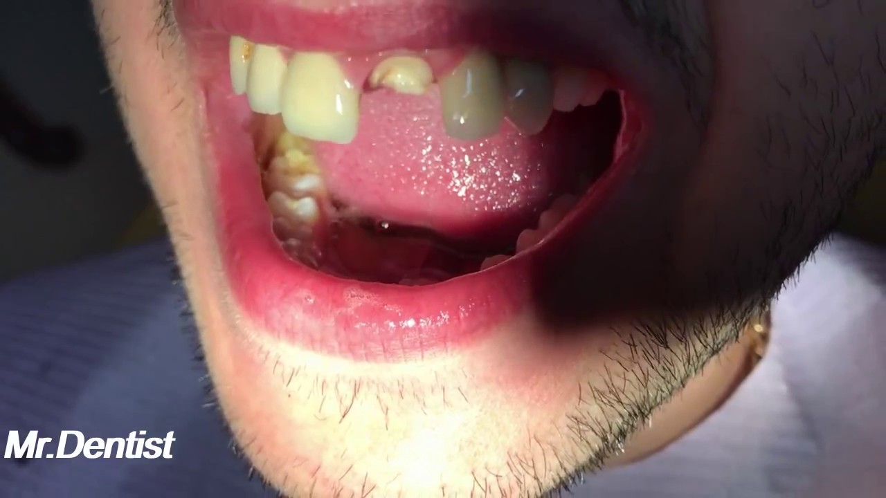 Dental Crown On Front Teeth - ALL CERAMIC CROWN !! - YouTube