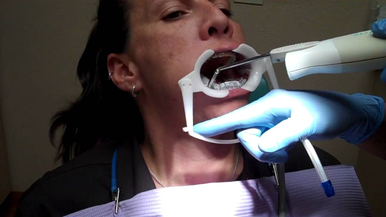 SureSmile Scan - YouTube