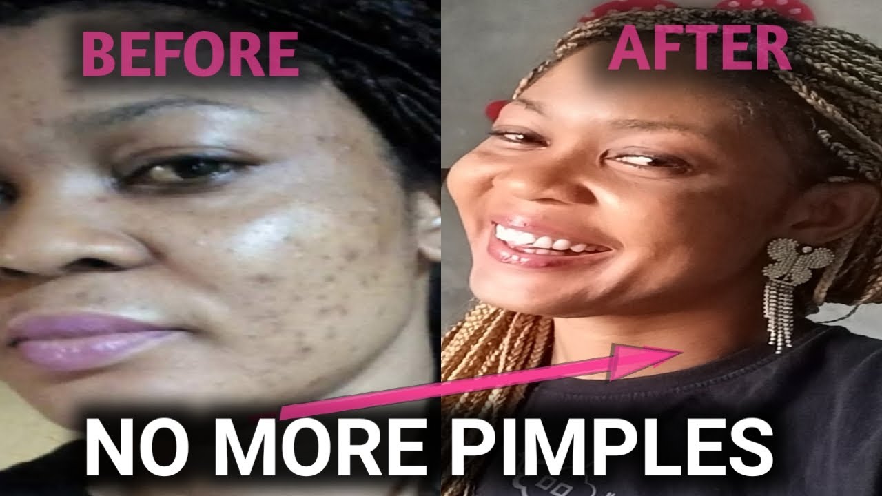 HOW I RID MY FACE OF PIMPLES/ACNE//BEST WAY TO REMOVE PIMPLES MARKS ...
