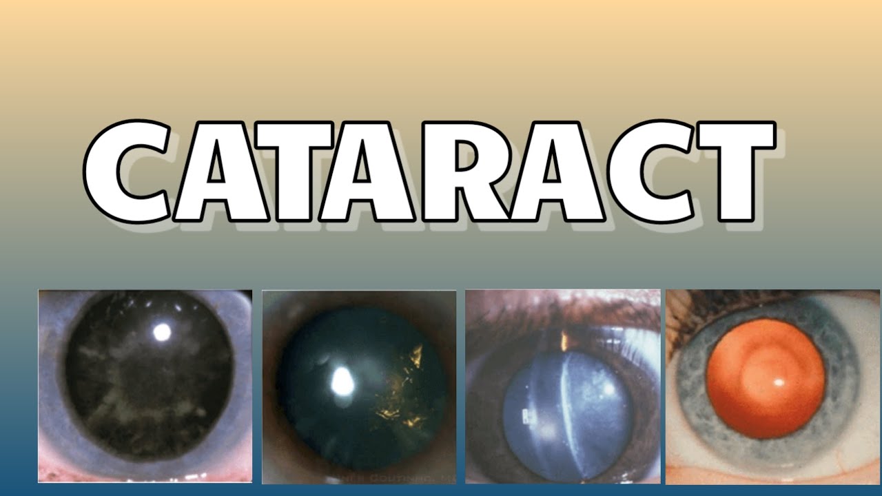 CATARACT / important Points about cataract / #cataract #ophthalmology # ...