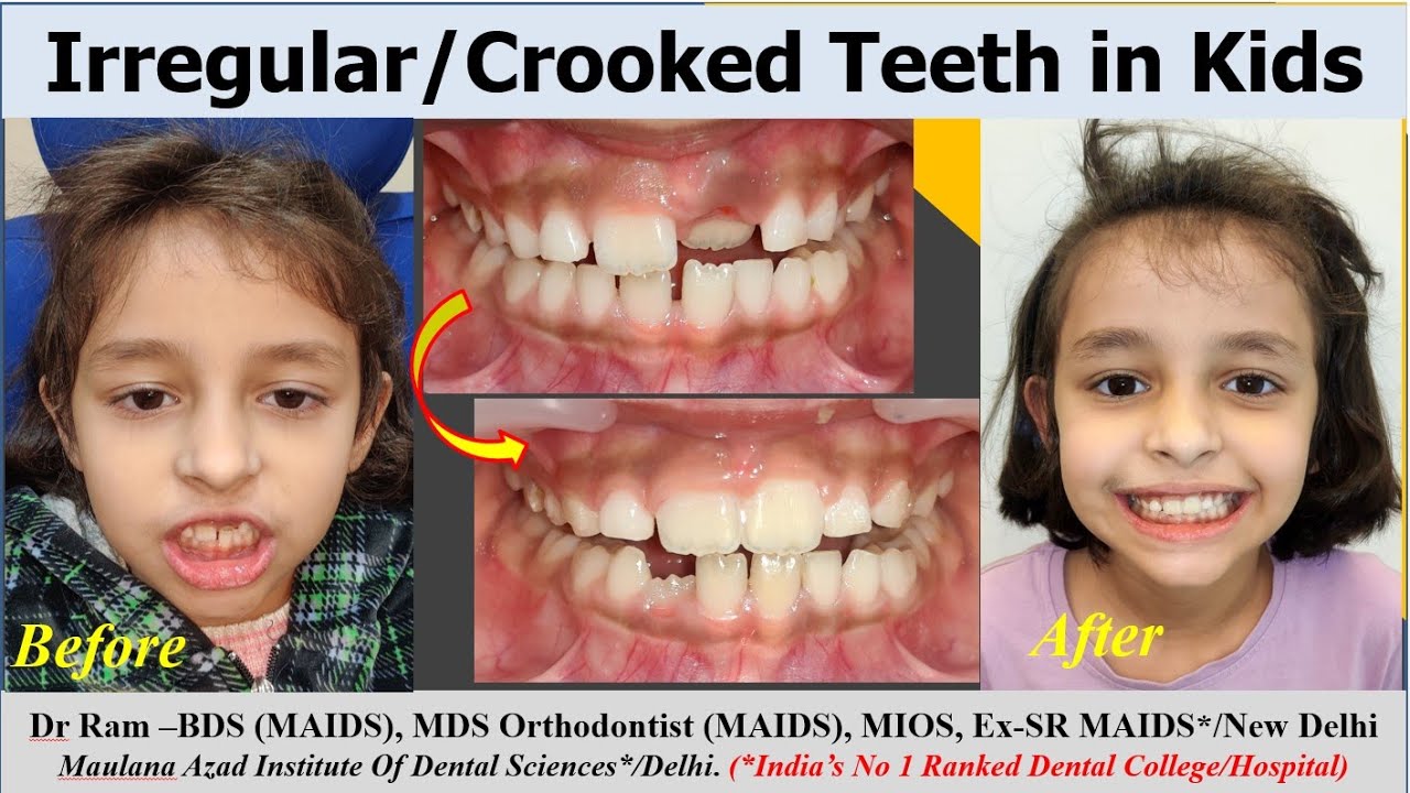 Crooked/ Irregular Teeth in Kids. Full Clinical Guide for Management of ...