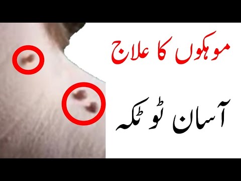 Mokon ka asan gharelu ilaj | Mason ka ilaj | Remedy for warts , blackheads and whiteheads | Warts