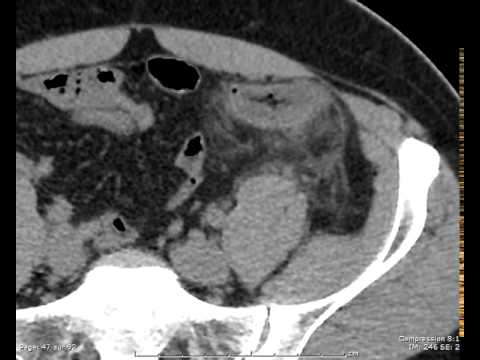 sigmoidite scanner ciné - YouTube
