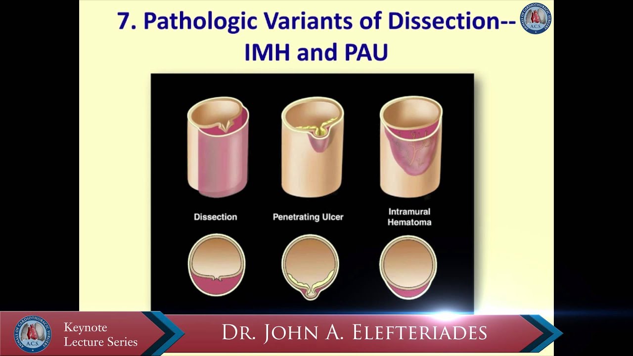 Natural history of Type B aortic dissection: ten tips - YouTube