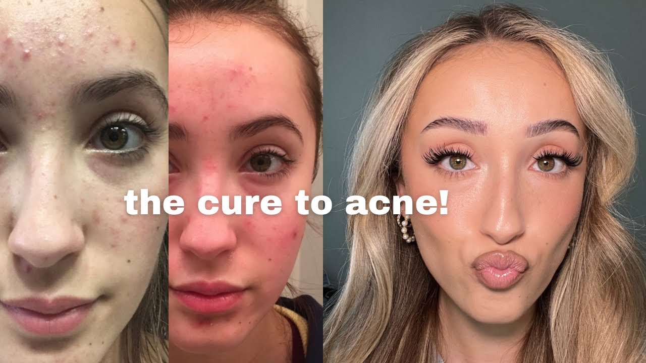 HOW TO GET RID OF ACNE FOR GOOD - my acne journey, accutane experience ...