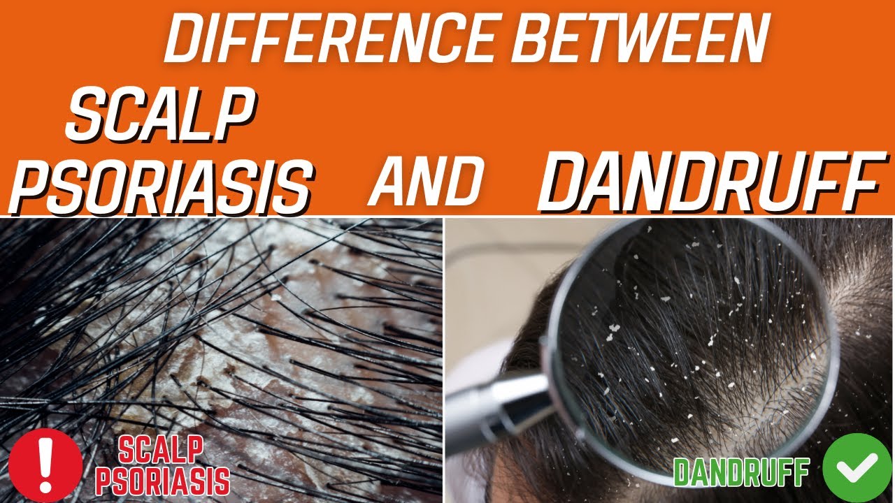 Difference between Dandruff and Scalp Psoriasis - YouTube