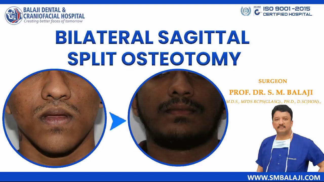Bilateral Sagittal Split Osteotomy - YouTube