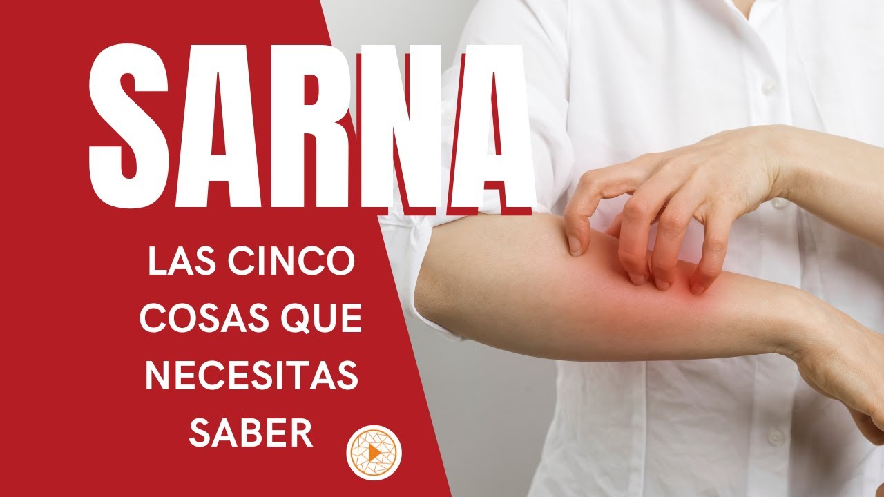 SARNA | Las 5 cosas que necesitas saber - YouTube