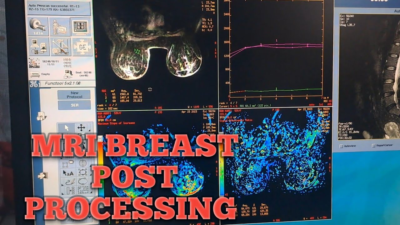 #Post processing of MRI Breast on GE 1.5 Tesla. - YouTube