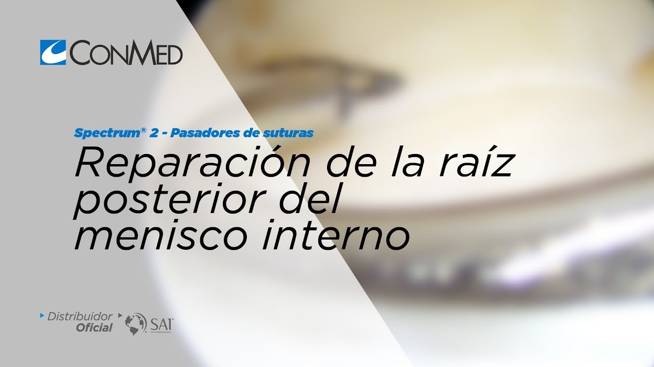 CONMED | Spectrum® 2 - Reparación raiz posterior del menisco interno ...