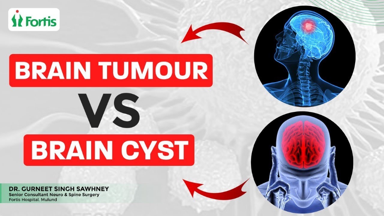 Brain Tumour Vs. Brain Cyst In Hindi | Kya Brain Cyst Life-Threatening Ho Sakta Hai? | MUL - YouTube