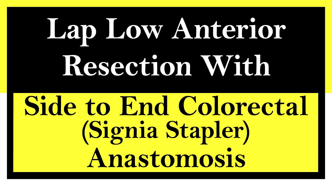 Lap Low Anterior Resection With Side to End Colorectal (Signia Stapler ...