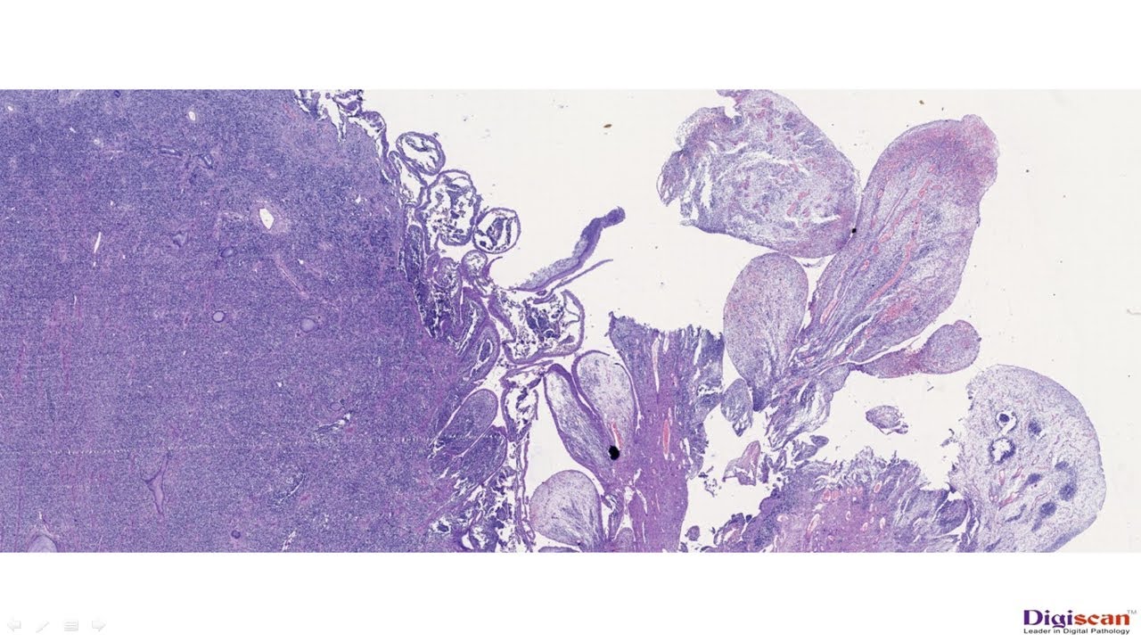 FGT: Embryonal Rhabdomyosarcoma - A Rare Uterine Mesenchymal Tumour ...