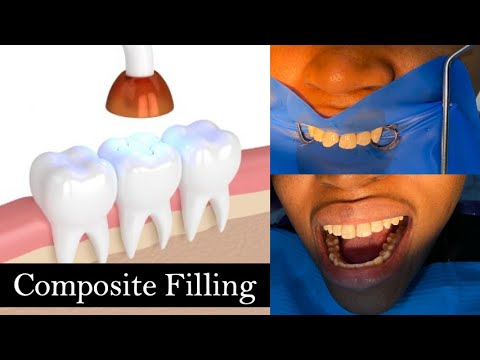 Composite Dental Filling Procedure - YouTube