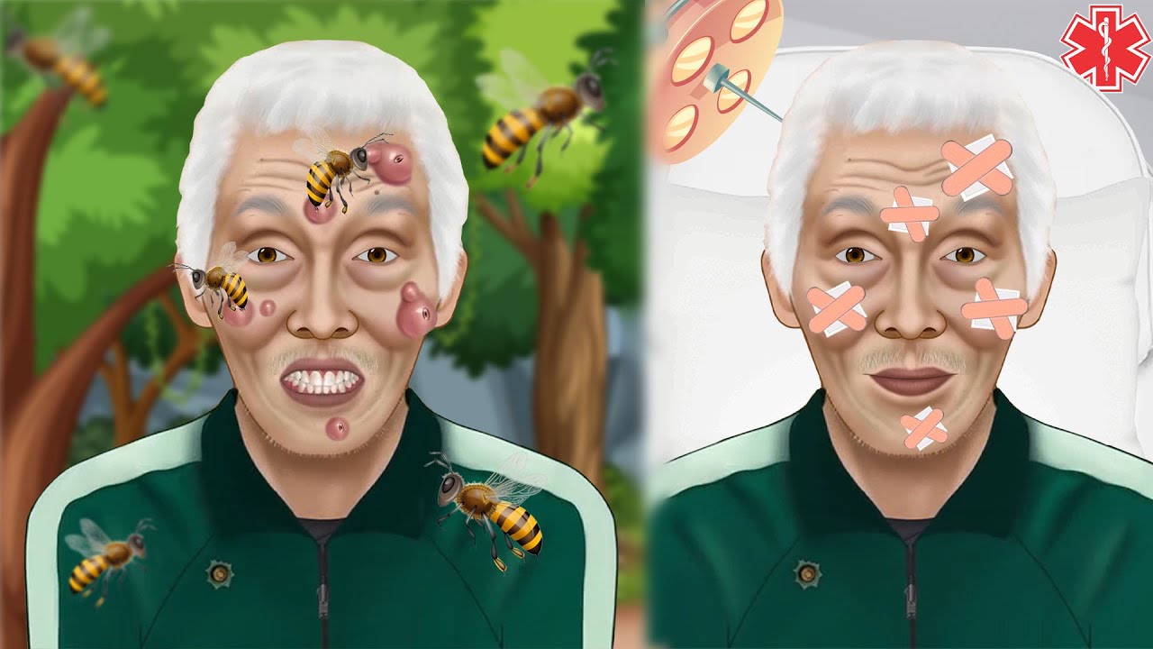 ASMR removing huge swollen bee stings wound treatment | Severely ...