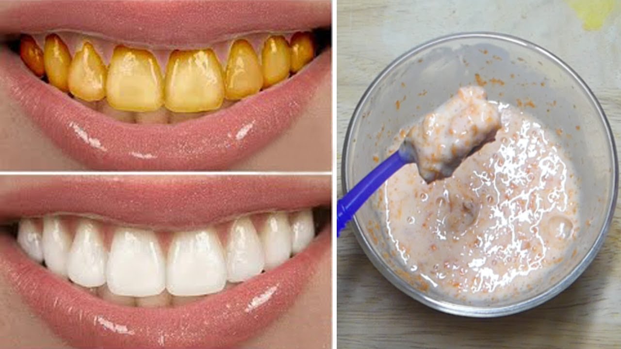 Teeth whitening at home in 5 minutes-How to naturally whiten your ...