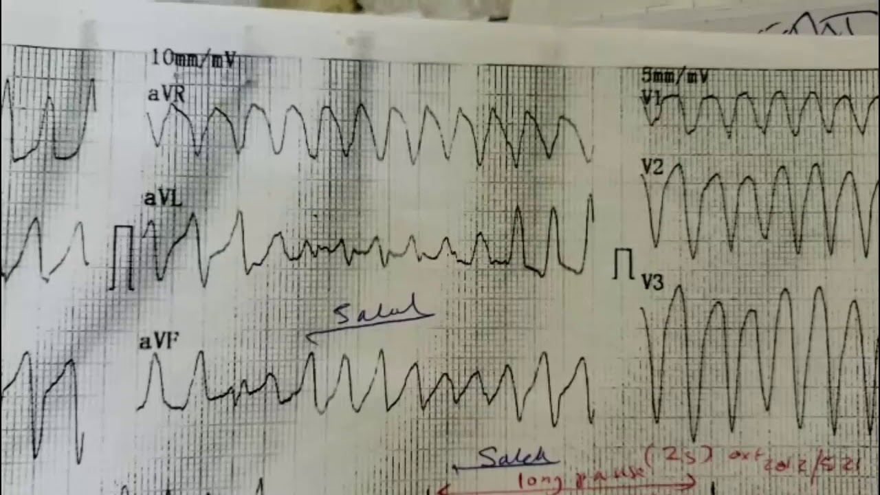 Polymorphic VT (Tdp) - By Prof Saleh Al Awdhaly - YouTube