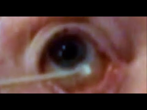 Apply Eye Ointment with a Toothpick - YouTube