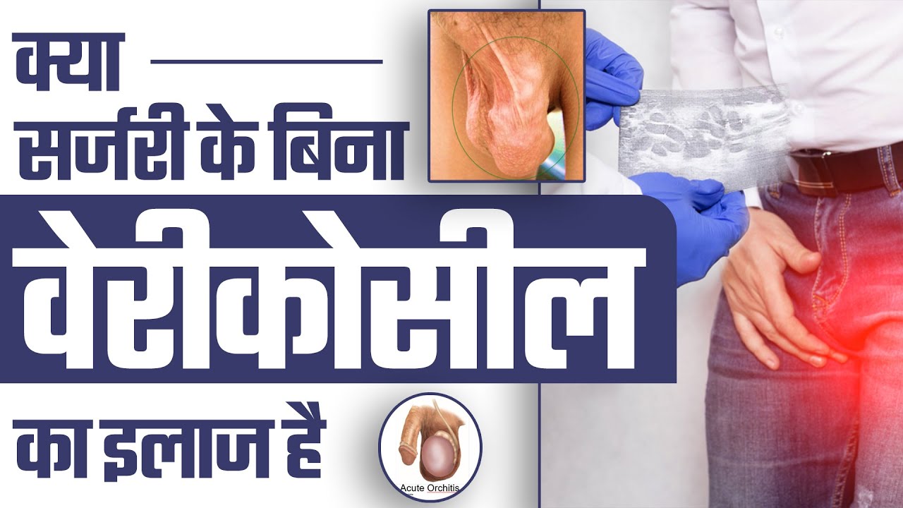 Varicocele Causes And Symptoms क्या सर्जरी के बिना वेरीकोसील का इलाज है