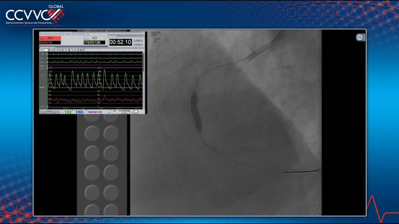 PCI of mRCA with Orbital Atherectomy - 2018 CCC Live Case 6 - YouTube