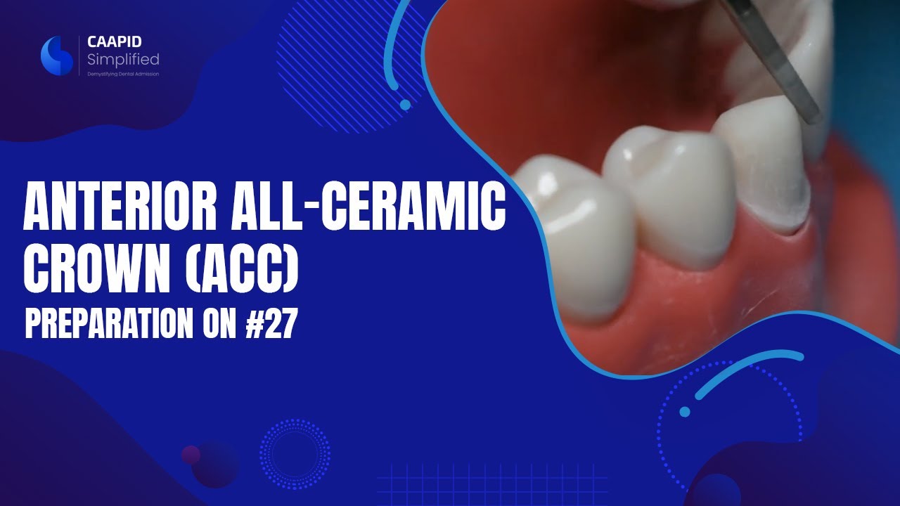 Anterior All-Ceramic Crown (ACC) Preparation on #27 | Caapid Simplified ...