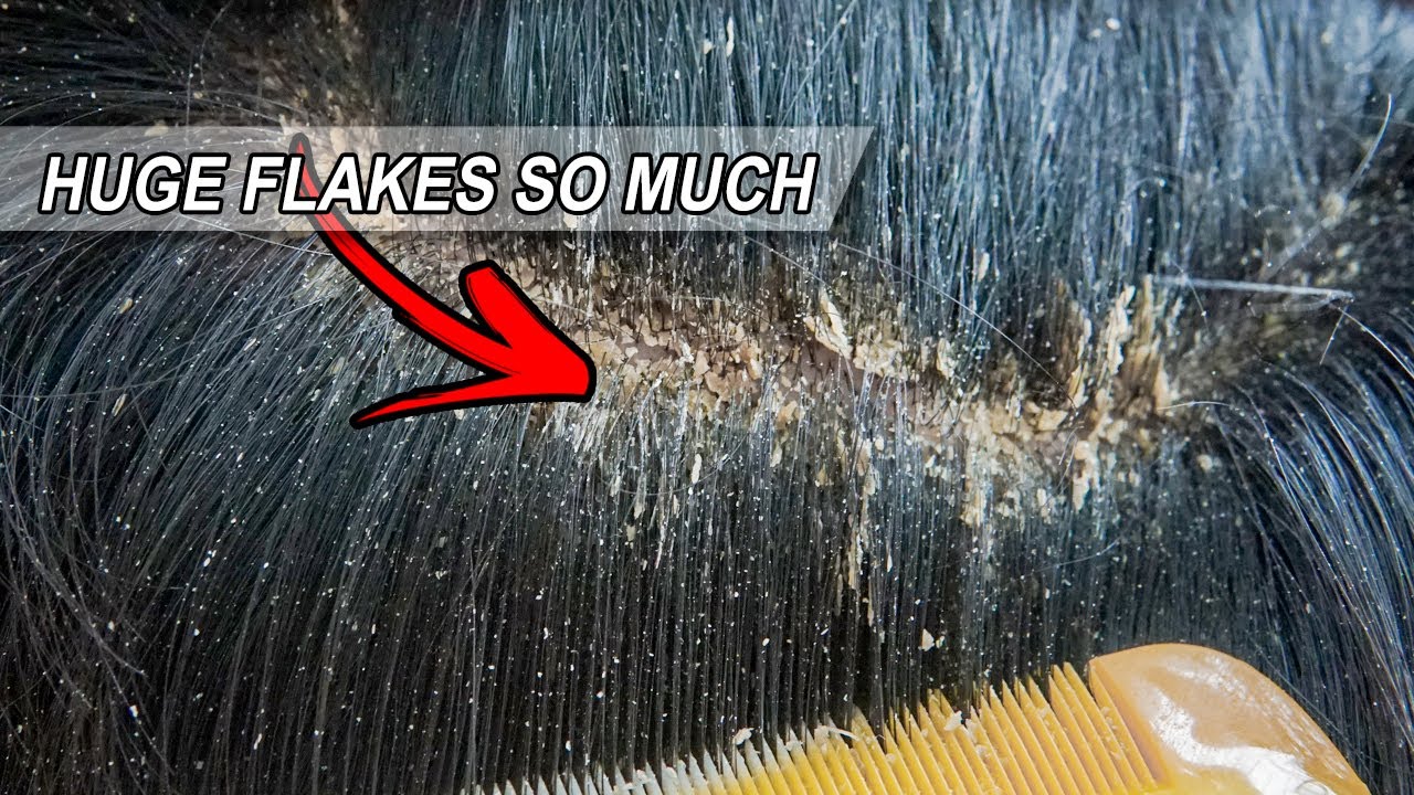 Dandruff Removal Comb Out!!! Satisfying Scalp Scratch (Big Flakes ...