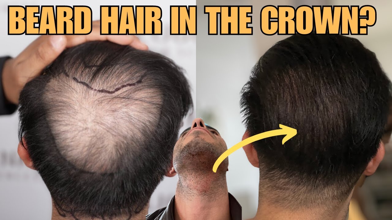 Can You Transplant Beard Hair In The Crown? Dr. Felipe Pittella Answers ...