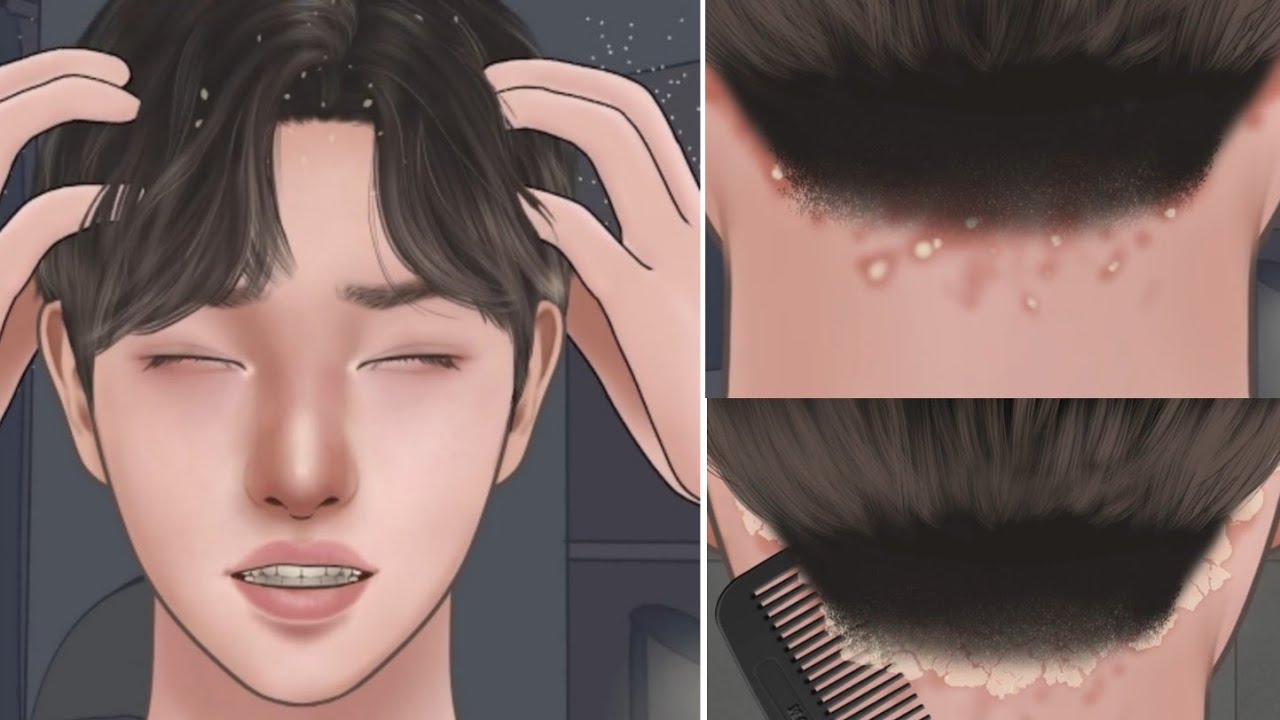 Big Flakes Dandruff Scratching [ASMR] Animation - YouTube