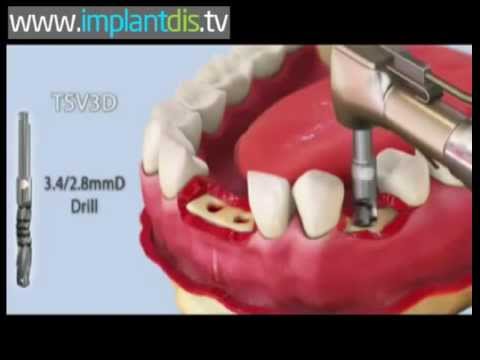 Zimmer implant - YouTube