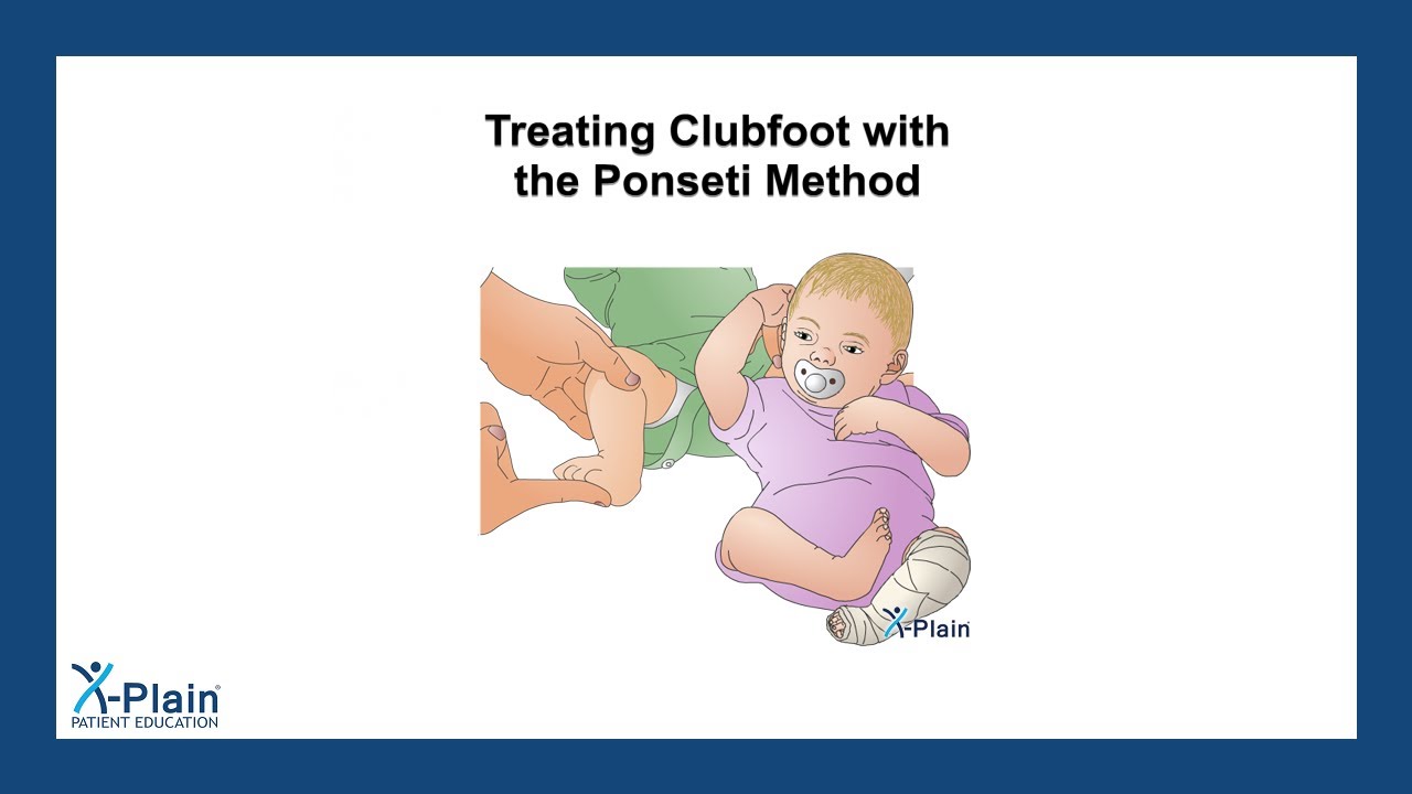 Treating Clubfoot with the Ponseti Method - YouTube
