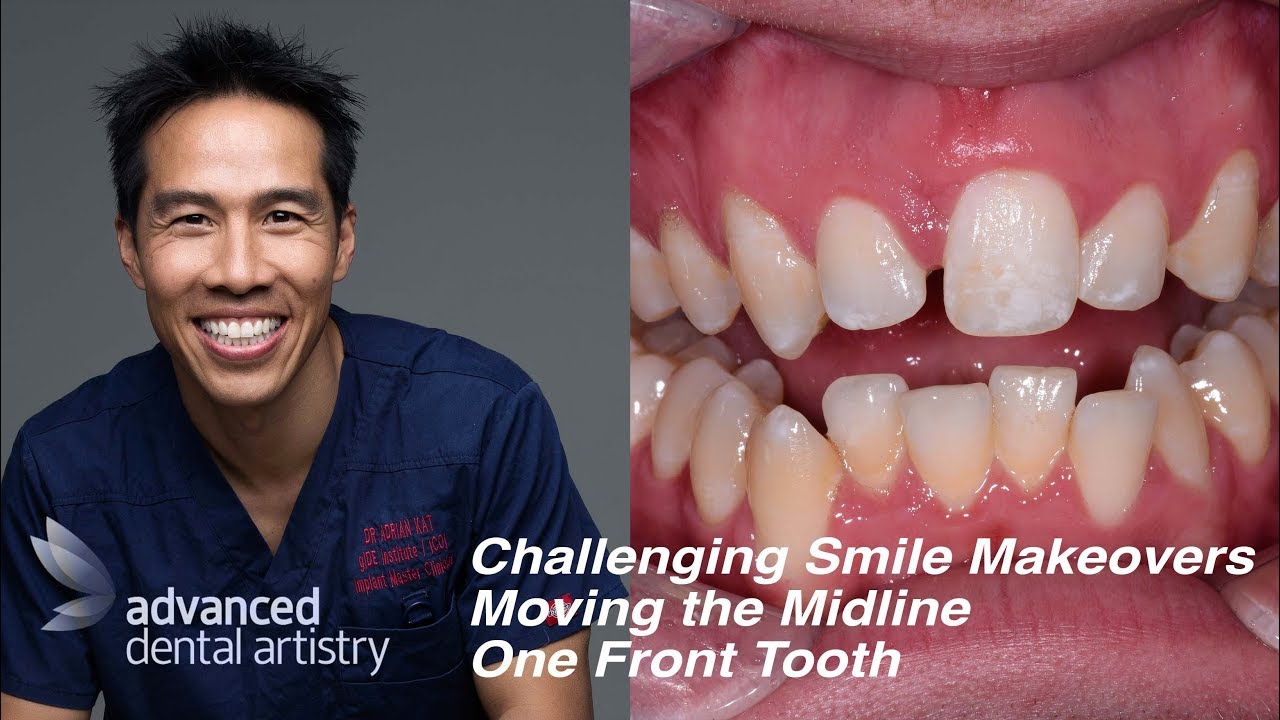 Difficult and Challenging Smile Makeover - One Central Tooth - Moving ...