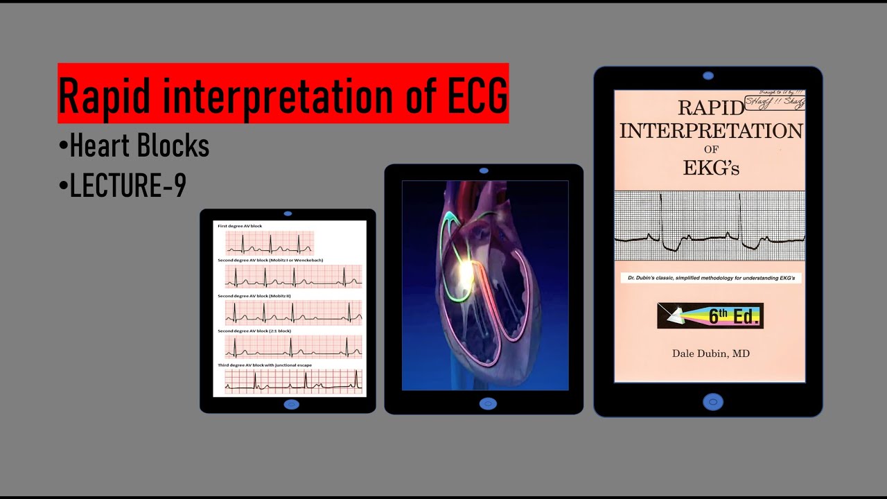 9.Understanding Heart Blocks | Rapid Interpretation of ECG (Video 9 ...