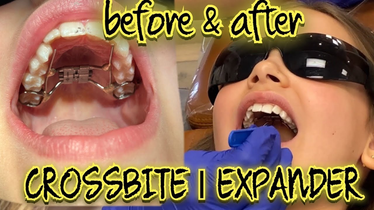 FIXING MY CROSSBITE AT 8 YRS OLD | HOW THEY PUT MY EXPANDER IN | THE ...