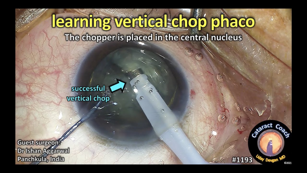 CataractCoach 1193: learning vertical chop phaco - YouTube