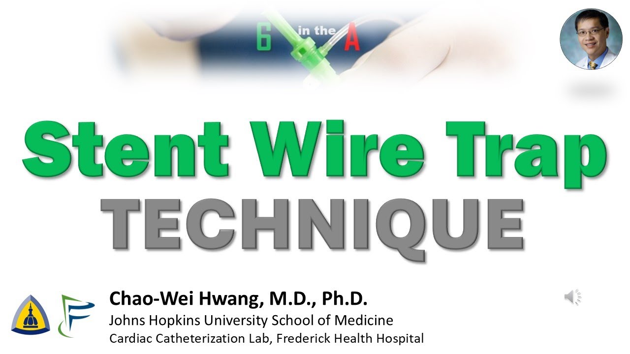 Stent Wire Trap Technique - YouTube