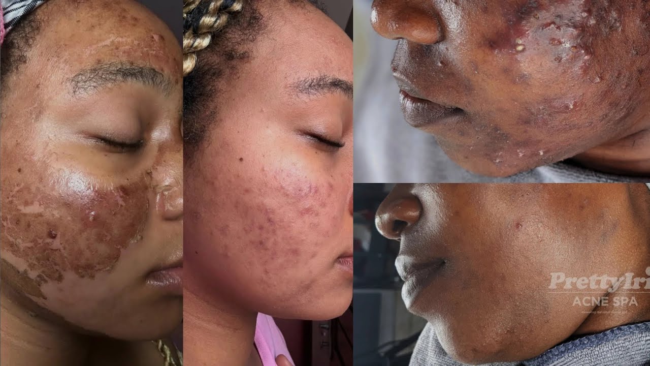 CLEAR ACNE PIMPLES WITH THESE THREE (3) TIPS - YouTube