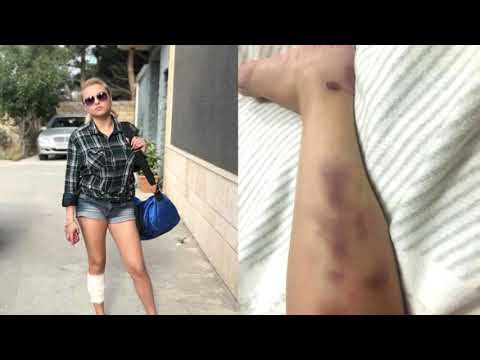 Azərbaycanlı aktrisa ikinci mərtəbədən yıxıldı  - FOTOLAR